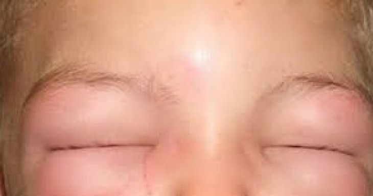 L'oedème de Quincke - Actualités - Sante-dz