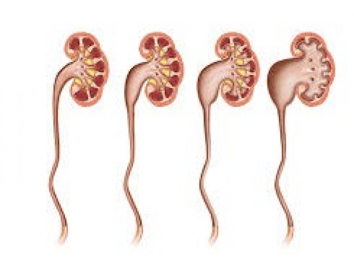 L'hydronéphrose - Actualités - Sante-dz