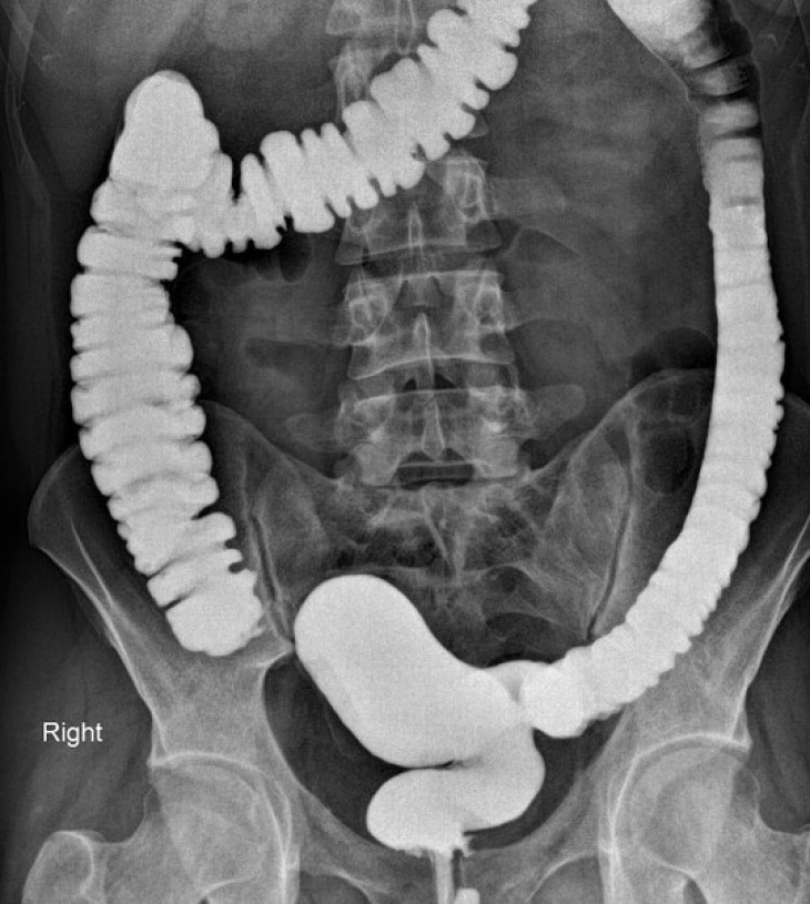 Le dolichocôlon - Conseils - Sante-dz