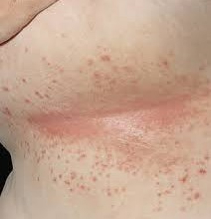 Intertrigo - Conseils - Sante-dz