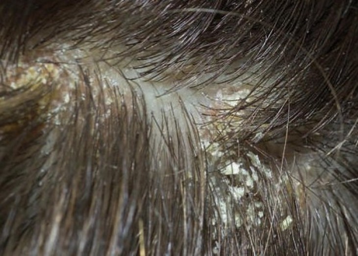 La dermatite séborrhéique de l'adulte - Actualités - Sante-dz